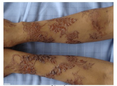 6 Steps How to Treat an Infected Tattoo - Take in Consideration (2019)